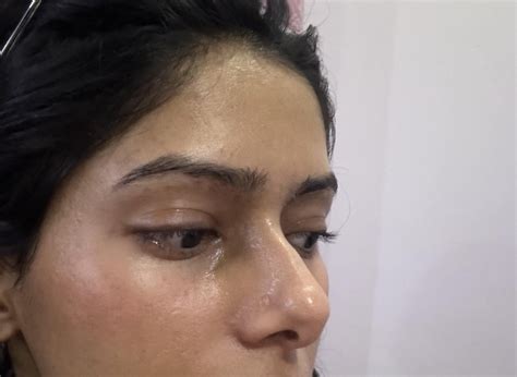 Hyperpigmentation Inbetween Nose And Eye Corners Rskinwhitening