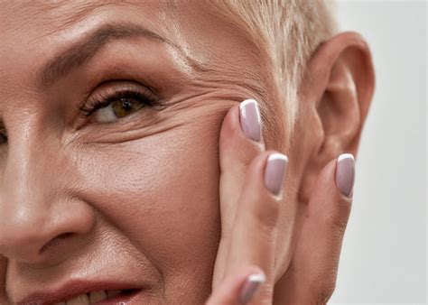 Lines And Wrinkles Daleswood Aesthetics Solihull