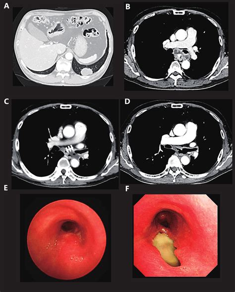 Computed Tomography Ct And Bronchoscopy A Chest Ct Showing The