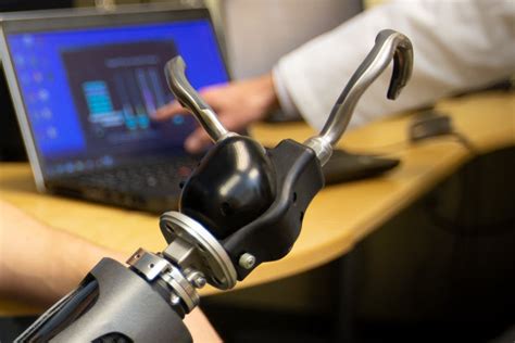 Introduction To Myoelectric Prostheses