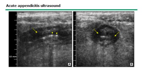 Appendectomy Cholecystectomy Hernia Repair Hemorrhoidectomy Flashcards Quizlet