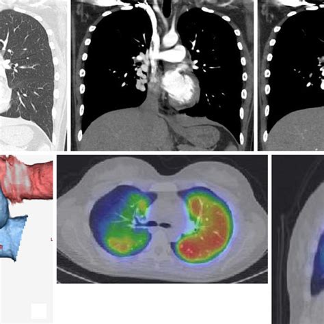 Transthoracic Echocardiogram Showing Patent Ductus Arteriosus With Flow