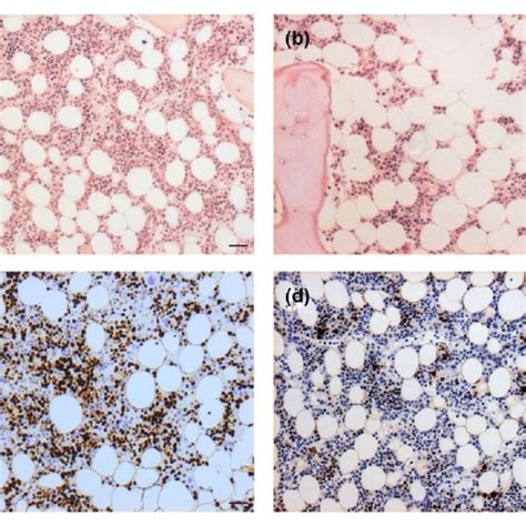 B And T Cell Infiltrates And Nodules In Bone Marrow Trephines From Download Scientific Diagram