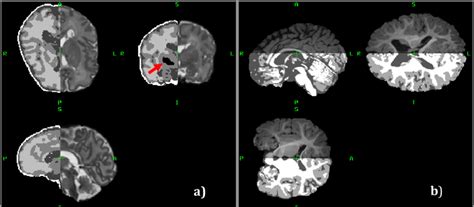 22 Typical Brain Segmentations Displayed Alongside The Acquired