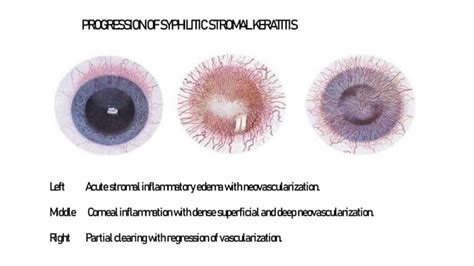 Interstitial Keratitis Powerpoint Presentation Pptx