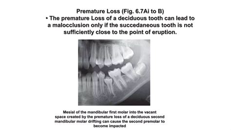 Common Etiological Factors Of Malocclusion Pptx