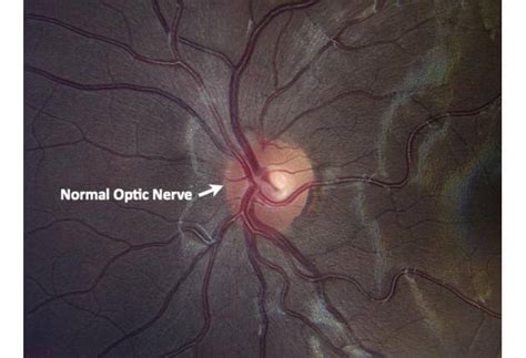 Optic Nerve Normal Wills Eye Hospital