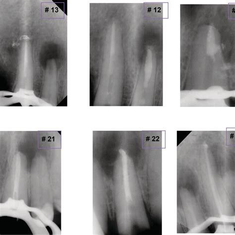 A Immediate Postoperative Periapical Radiograph B Periapical