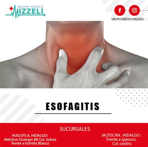 La Esofagitis Es Una Inflamación Grupo Médico Mizzeli