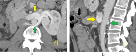 Axial Contrast Enhanced Ct With Thin Mip Reformatting In Axial A And