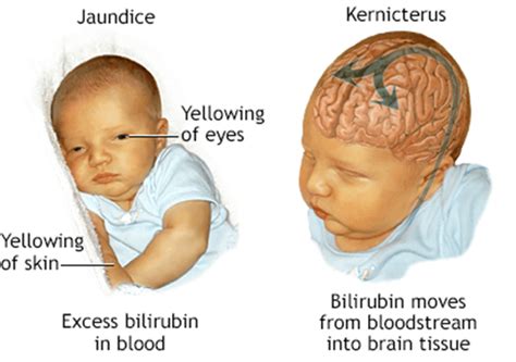 Hyperbilirubinemia Maternal And Newborn
