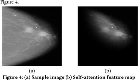 Figure 1 From Mammography Data Augmentation Using Acgan Semantic Scholar