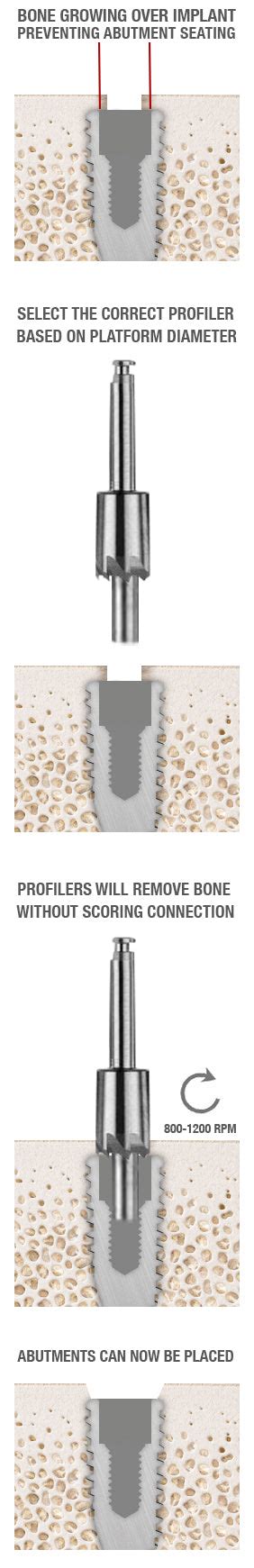 Universal Implant Bone Profiling Kit Avtec Dental
