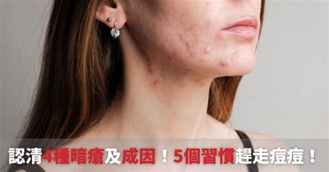 【暗瘡急救】暗瘡3大成因及種類！5個習慣改善痘痘問題！