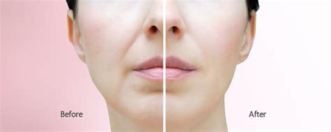Nasolabial Fold Fillers Elite Aesthetics