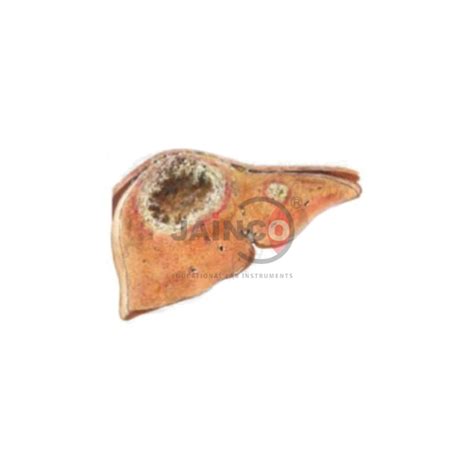 Amoebic Liver Abscess Model India Manufacturers Suppliers And Exporters