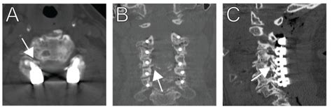 Management Of Malpositioned Cervical Interfacet Spacers An