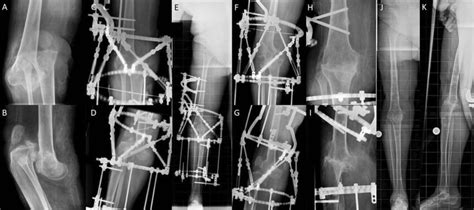 X Rays Of Knee Fusion Done For Chronic Right Knee Dislocation A And B Download Scientific