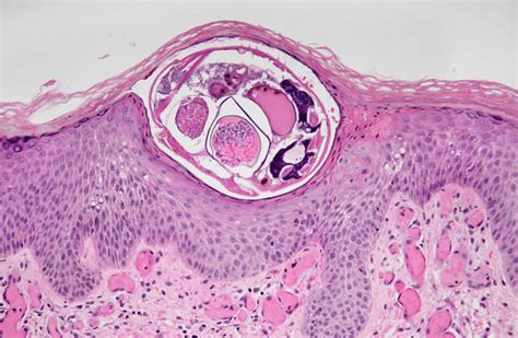 Skin Biopsy Showing Scabies Mites In The Epidermis Hande ×40