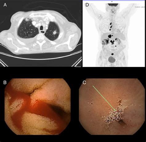 A Ct Image In Which A Spiculated Nodule In The Left Upper Lobe