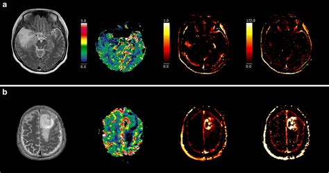 Representative MR Images With Perfusion And T2 Weighted Images Of An