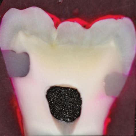 Restored Class V Cavities At The Cej On The Buccal And Lingual Surfaces Download Scientific