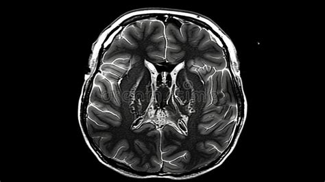 Detailed Ct Scan Of A Brain Displaying Advanced Atrophy Stock Image Image Of Atrophy