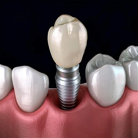 Proceso De Implante Dental Paso A Paso Y Plazos