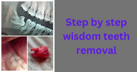 Step By Step Wisdom Tooth Removal A Pain Free Journey Favourite