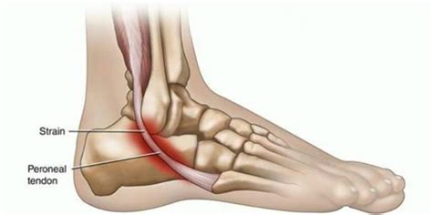 Peroneal Tendon Tear Surgery