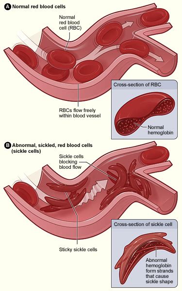 Sickle Cell Symptoms And Complications