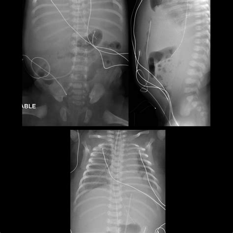 Premature Newborn After Umbilical Venous Catheter Placement Pediatric