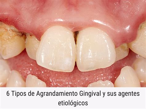 6 Tipos De Agrandamiento Gingival Ag Y Sus Agentes Etiológicos