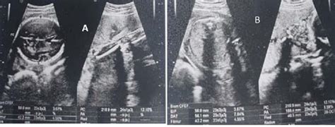 A And B Show Fetal Biometrics Download Scientific Diagram