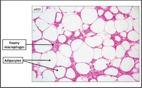 Figure 3 From Paradoxical Adipose Hypertrophy PAH After Cryolipolysis Semantic Scholar