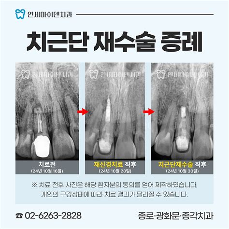 치근단절제술 후 염증 재발로 발치 진단 치근단 재수술 케이스 광화문치과 연세마이덴치과🦷