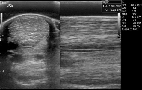 Superficial Digital Flexor Tendonitis On Thoroughbred Filly Equine