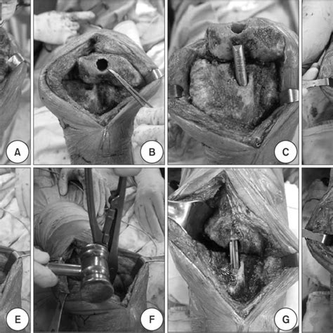 Surgical Techniques A The Tibia Was Reamed First To A Sufficient Download Scientific Diagram
