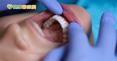 每年逾8千人罹口腔癌！影響「這些」重要功能 把握3原則遠離威脅 生活 Ctwant