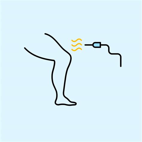 Radiofrequency Ablation For Veins Procedures At Metro Vein Centers
