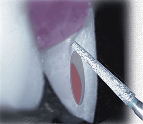 Porcelain Veneer Prepping 101 Burbank Dental Lab