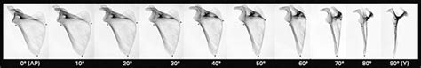 Scapula Fractures Clinical Tree