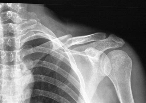 Clínica Traumacor Traumatólogos Coruña Fractura De Clávicula
