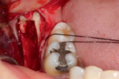 The Third Surgical Approach Was To Install An Onlay Autogenous Block