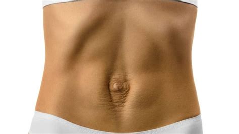 Rectus Diastase Telem1