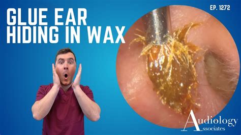 Glue Ear Hiding Behind The Wax — First Timers Bilateral Removal