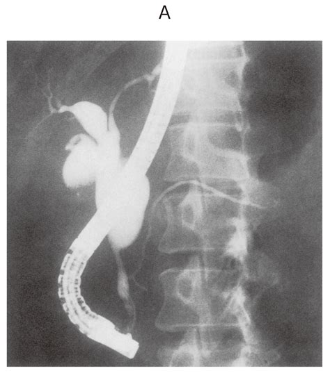 101g29 先天性胆道拡張症 膵・胆管合流異常症 国試 M3e Medical