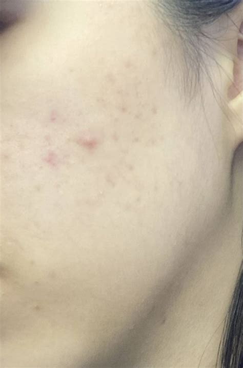 잡담 여드름 색소침착 없어지지를 않는다 인스티즈instiz 일상 카테고리
