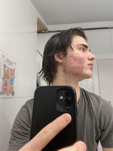Before And After Doxycycline Treatment Racne