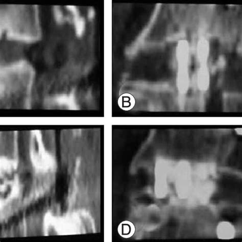 Bone Formation Grading System Which Is Measured At Out Of Cage